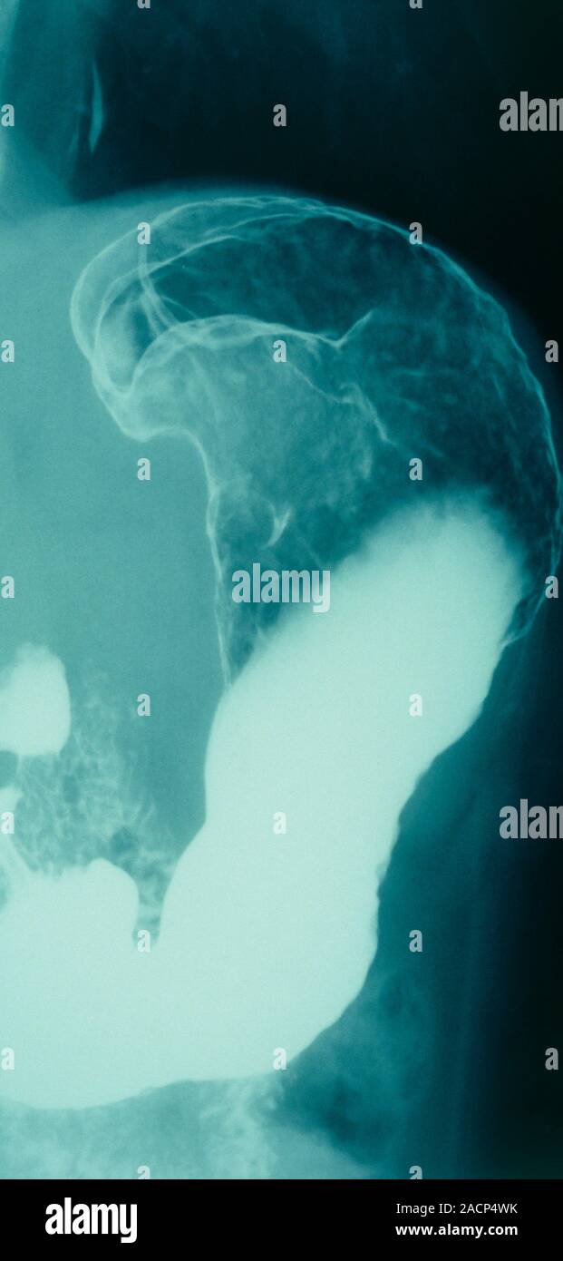 Stomach cancer. Coloured frontal X-ray of the upper gastroduodenal ...