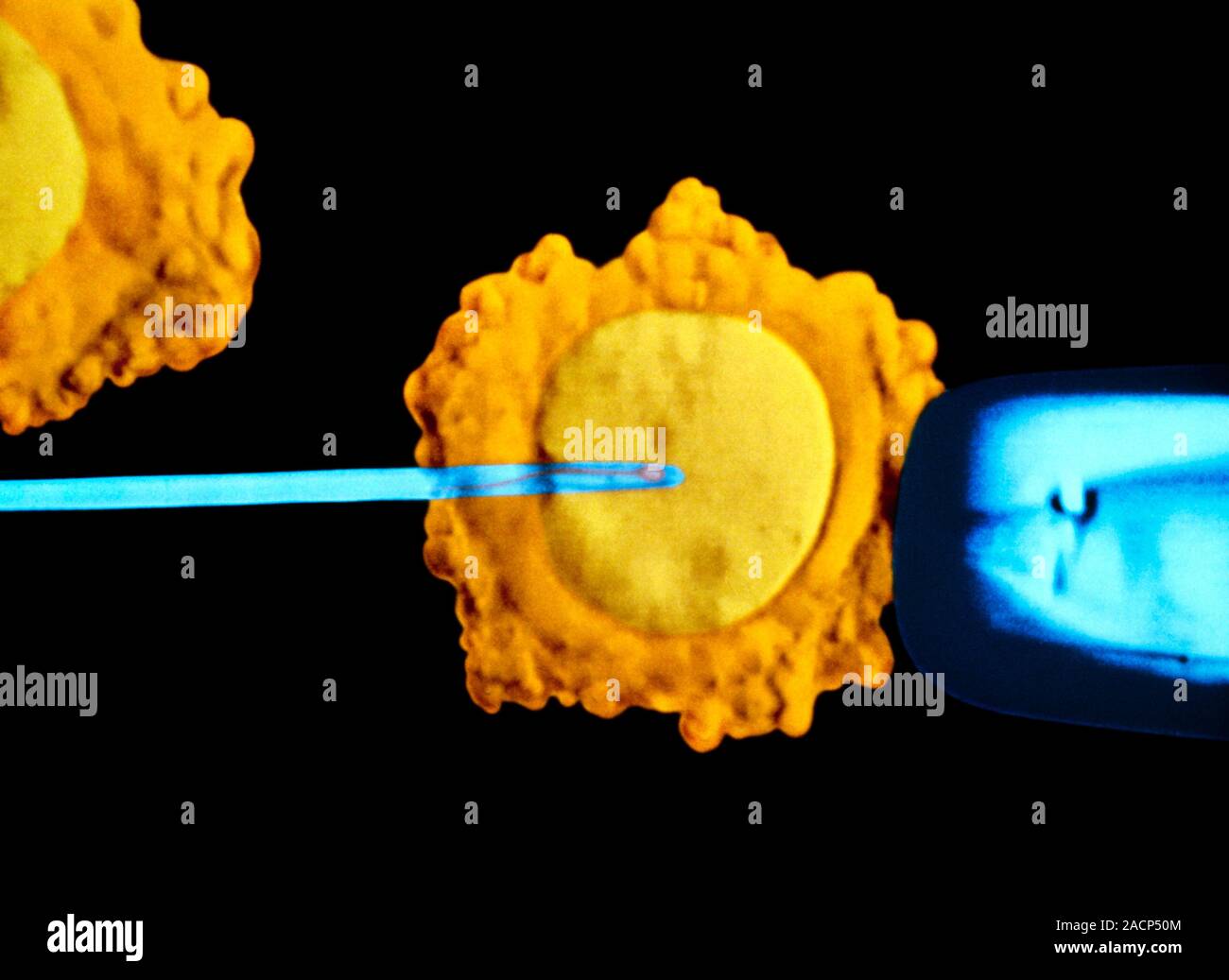 IVF treatment. Light micrograph of a micro-needle (bottom) injecting ...