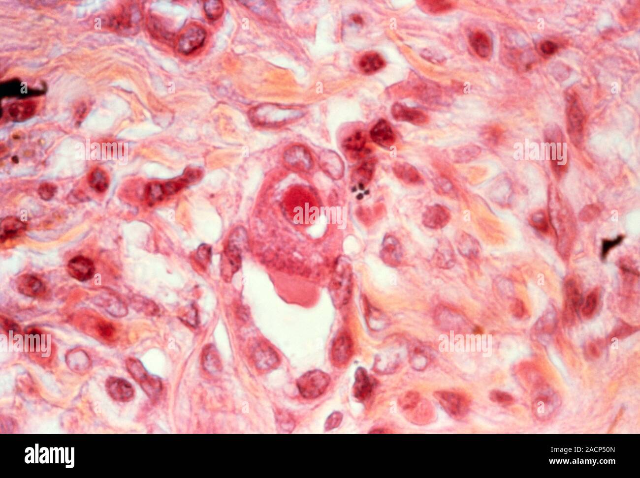 Cytomegalovirus infection. Light micrograph of lung cells showing ...