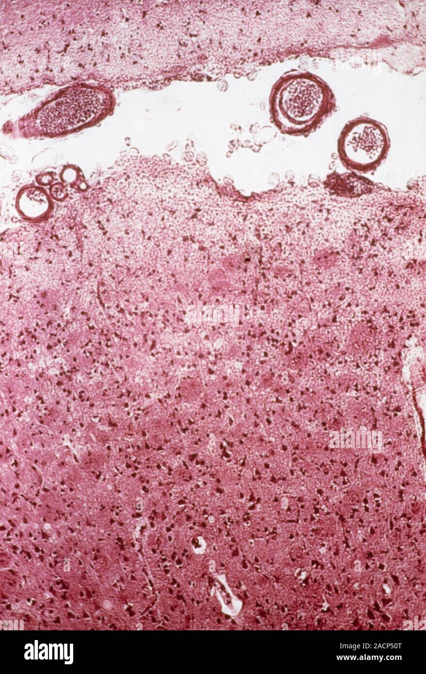 Dementia. Light micrograph of a section through the cerebral cortex of ...