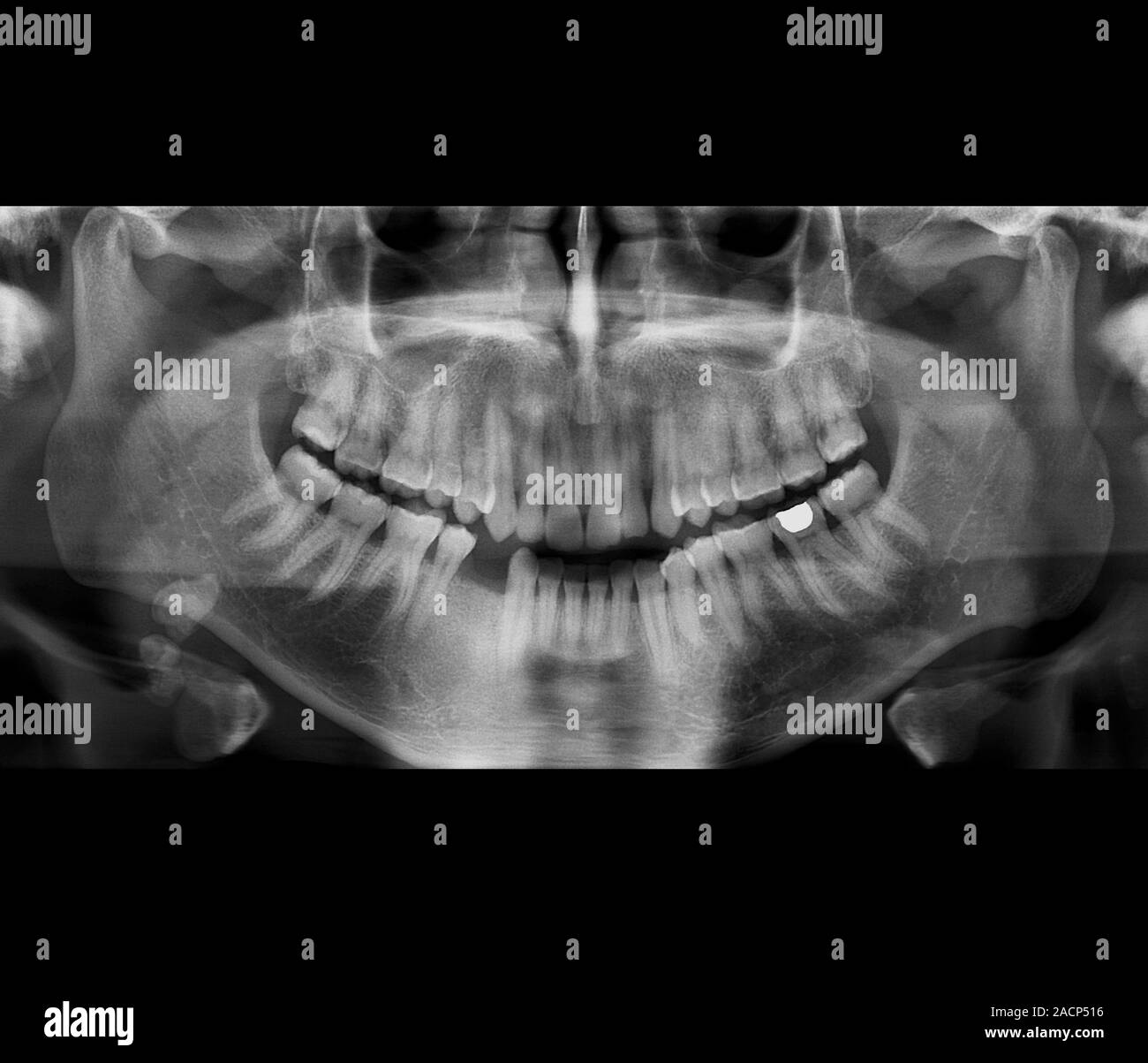 Salivary gland stone. X-ray of the jaw of a 36-year-old patient with a ...