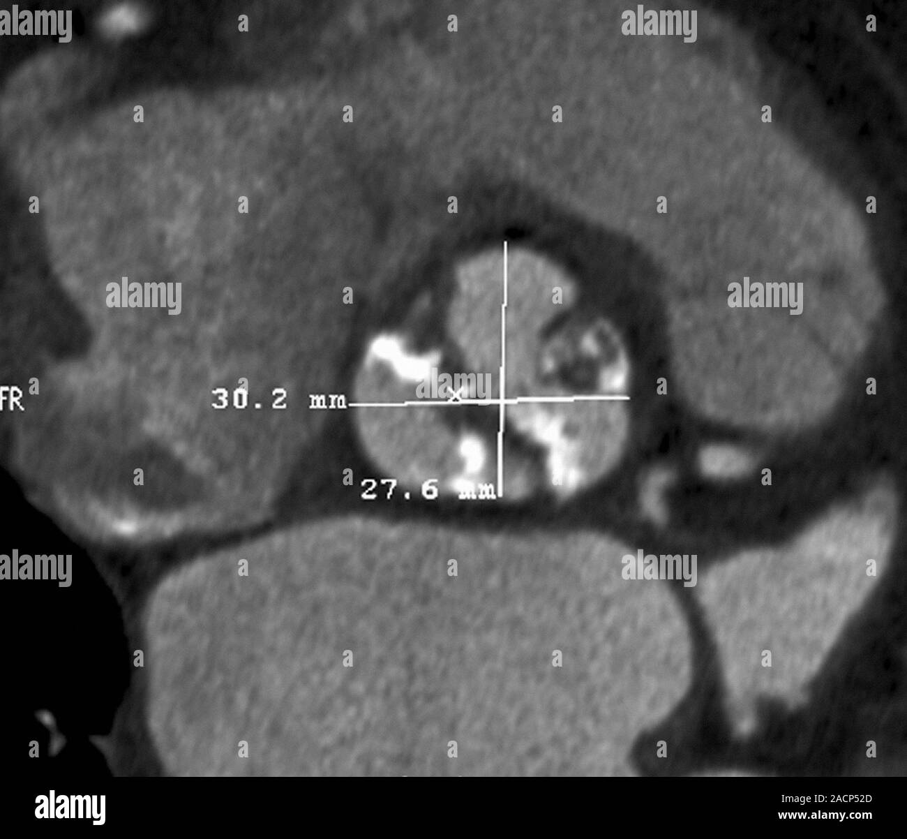 Calcified heart valve. Computed tomography (CT) scan of a section ...