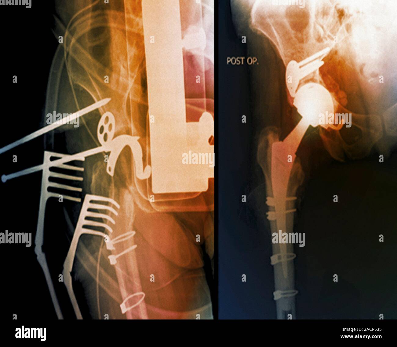 Total hip replacement. Coloured X-rays taken during (left) and after ...