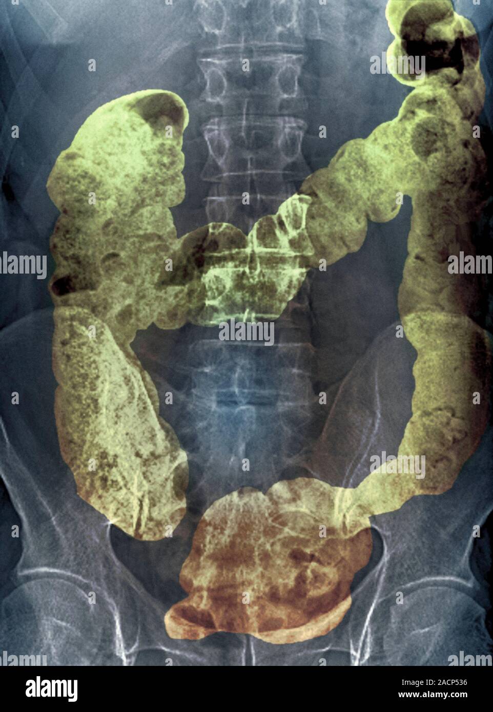 Constipation. Coloured X-ray of the bowels of a 52-year-old patient ...