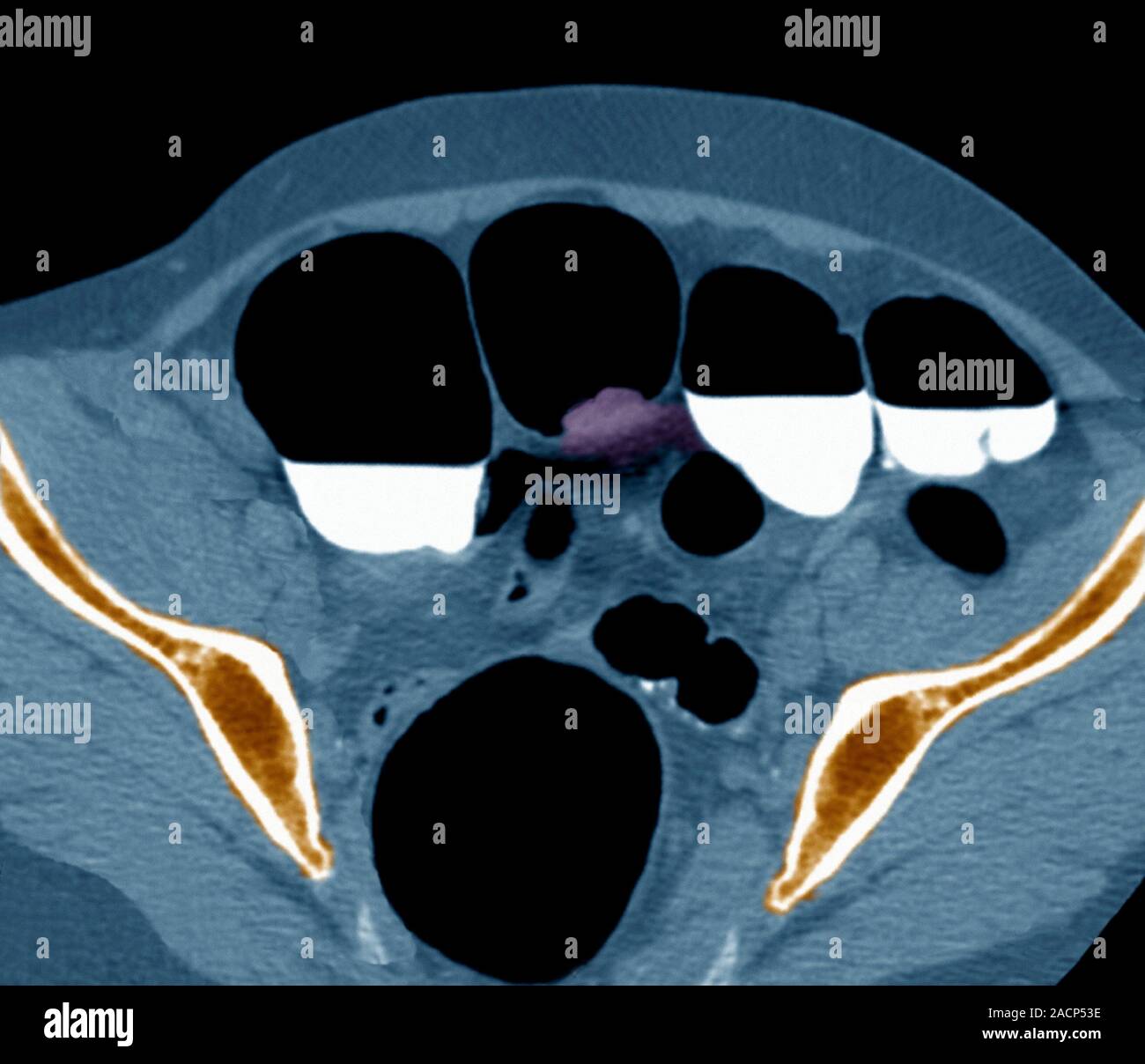 Colon cancer. Coloured barium contrast computed tomography (CT) scan of an axial section through ...