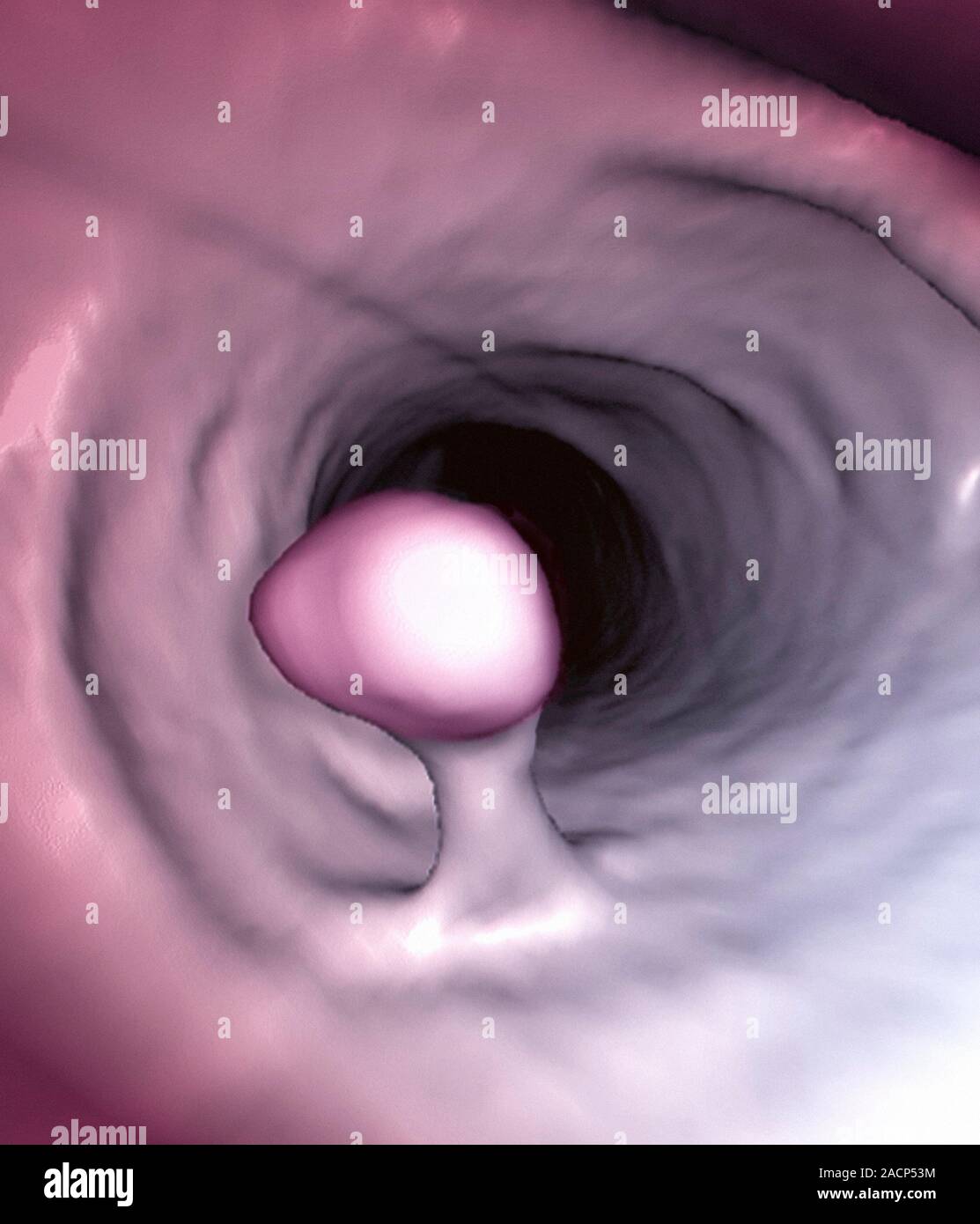 Colon Polyp Coloured 3d Computed Tomography Ct Colonoscopy Image Of A Pedunculated Stalked