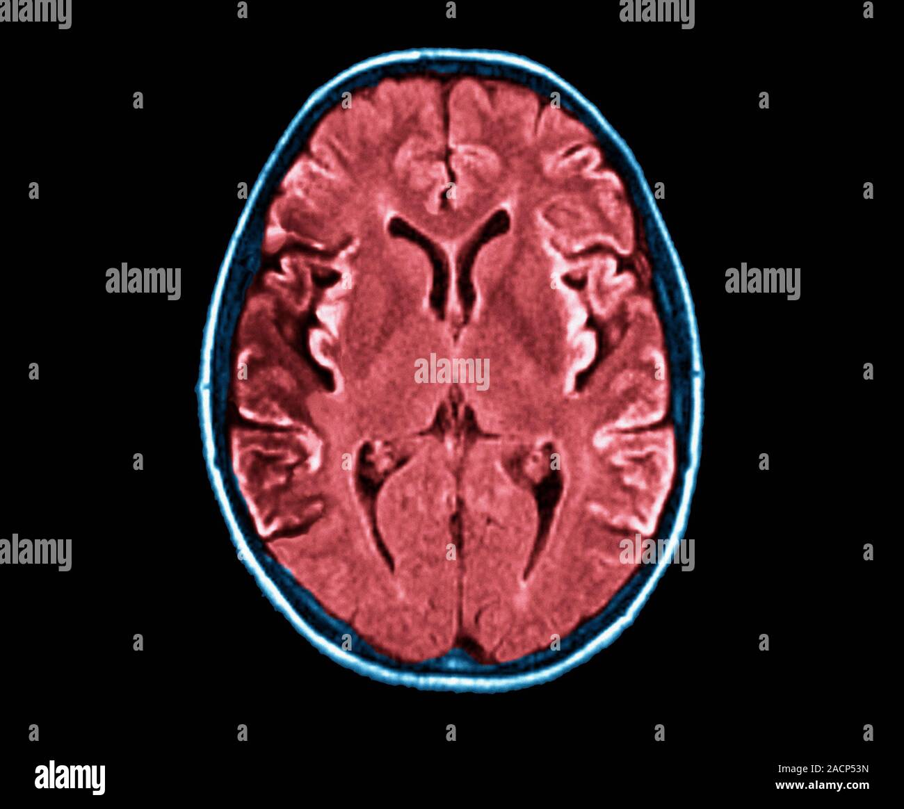 Creutzfeldt-Jakob disease. Coloured magnetic resonance imaging (MRI ...