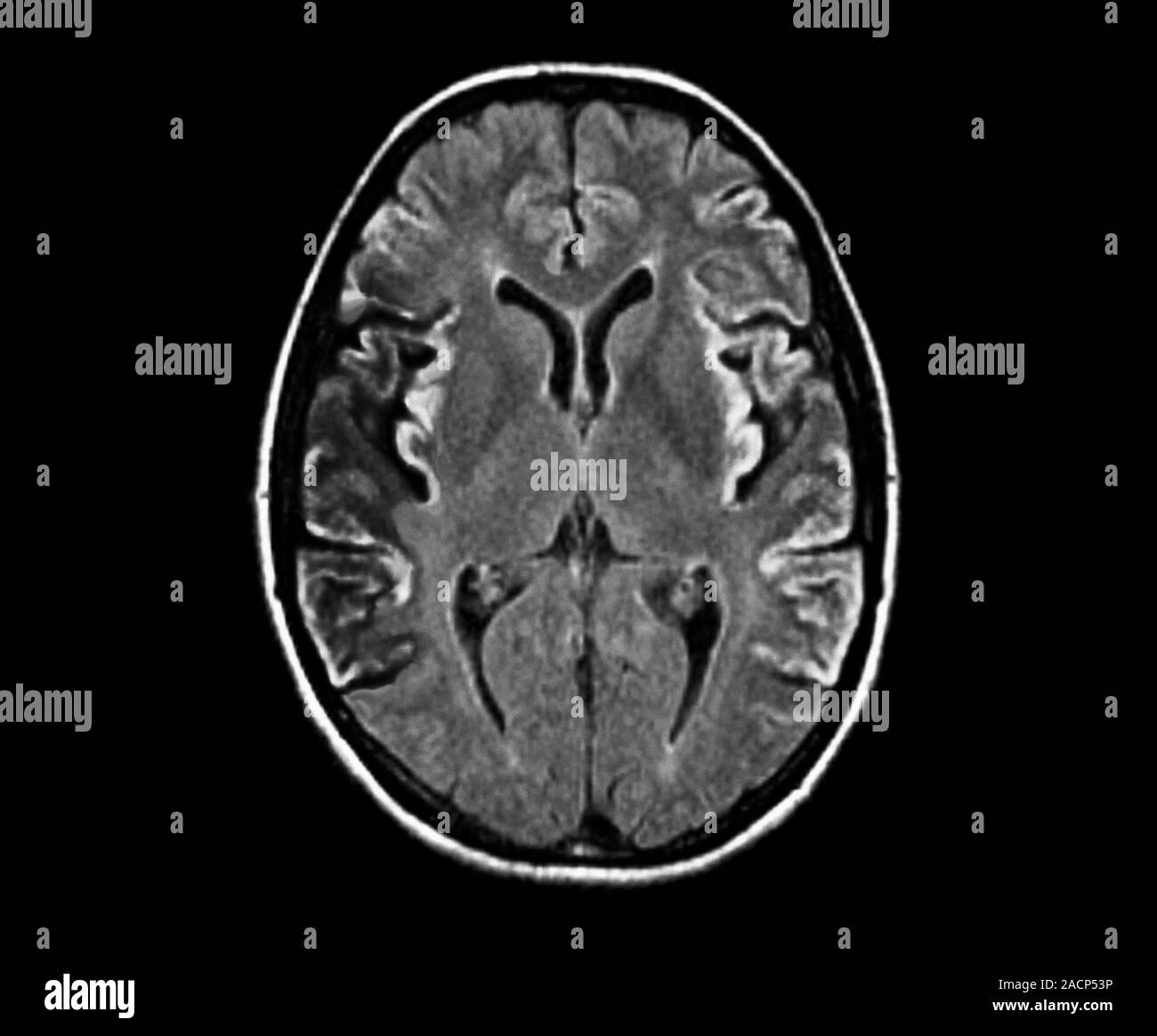 Creutzfeldt-Jakob disease. Magnetic resonance imaging (MRI) scan of an ...