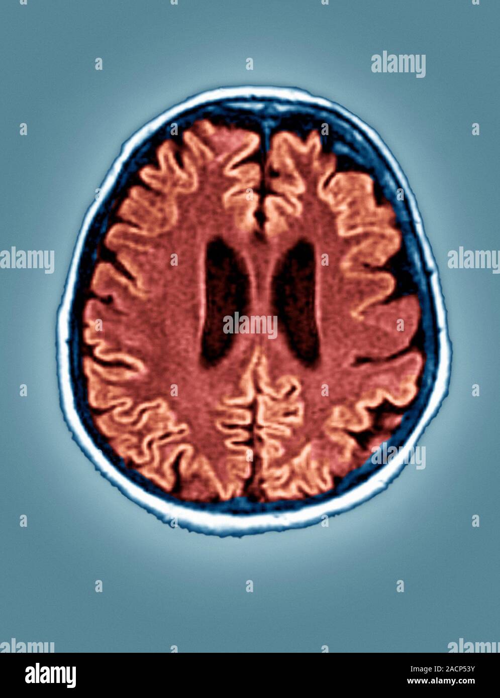 Creutzfeldt-Jakob disease. Coloured magnetic resonance imaging (MRI ...