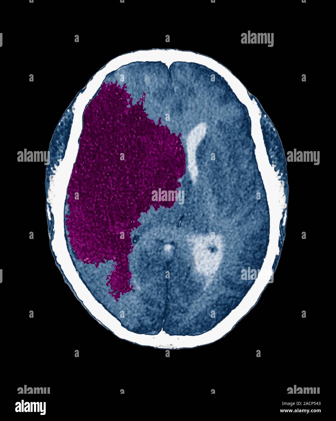 Stroke. Coloured computed tomography (CT) scan of an axial section through the brain of a 58 ...