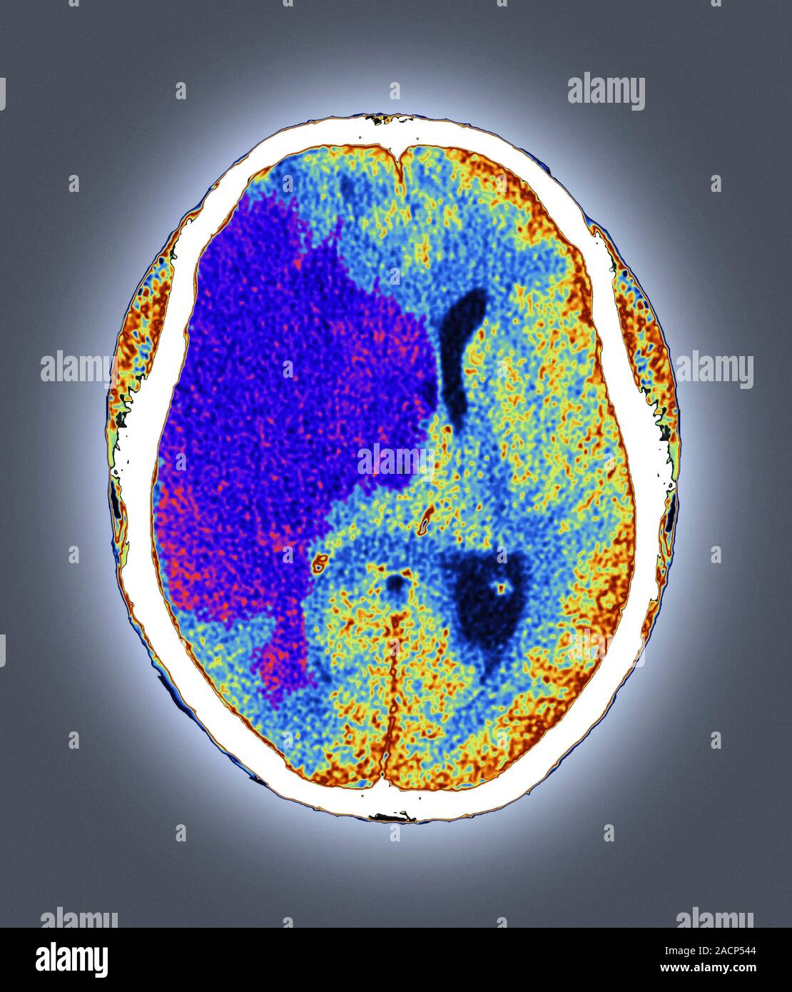Stroke Coloured Computed Tomography Ct Scan Of An Axial Section