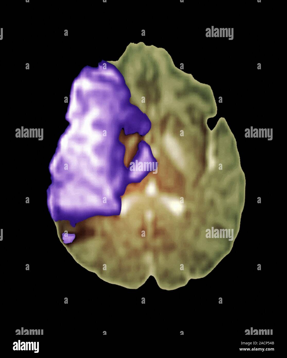 Stroke. Coloured magnetic resonance imaging (MRI) scan of an axial ...
