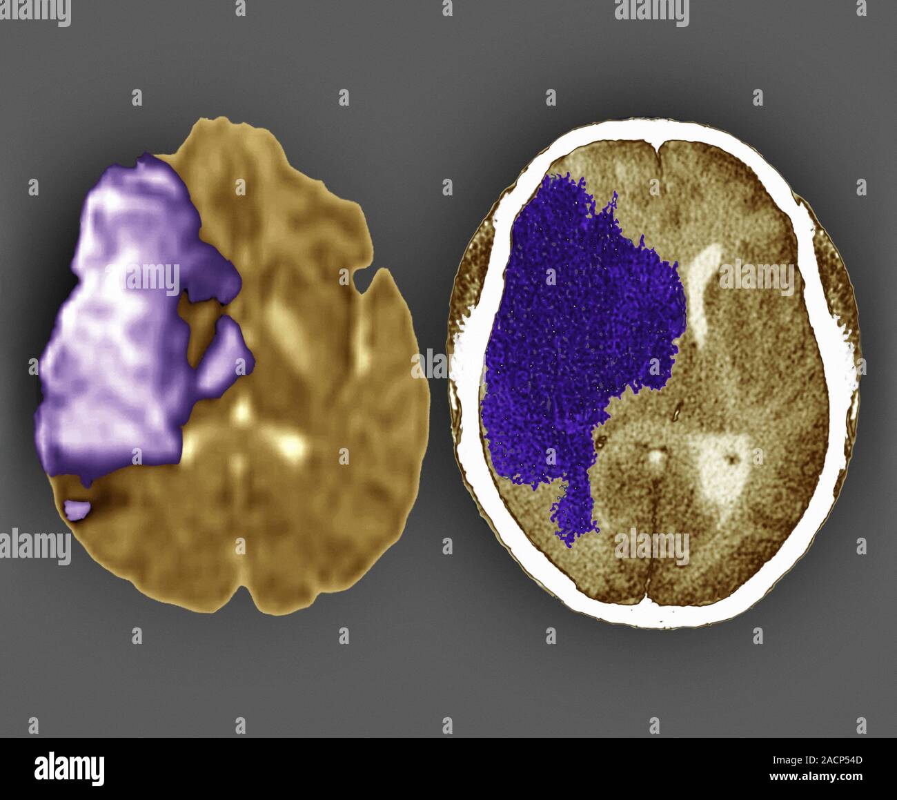 Stroke. Coloured magnetic resonance imaging (MRI, left) and computed ...