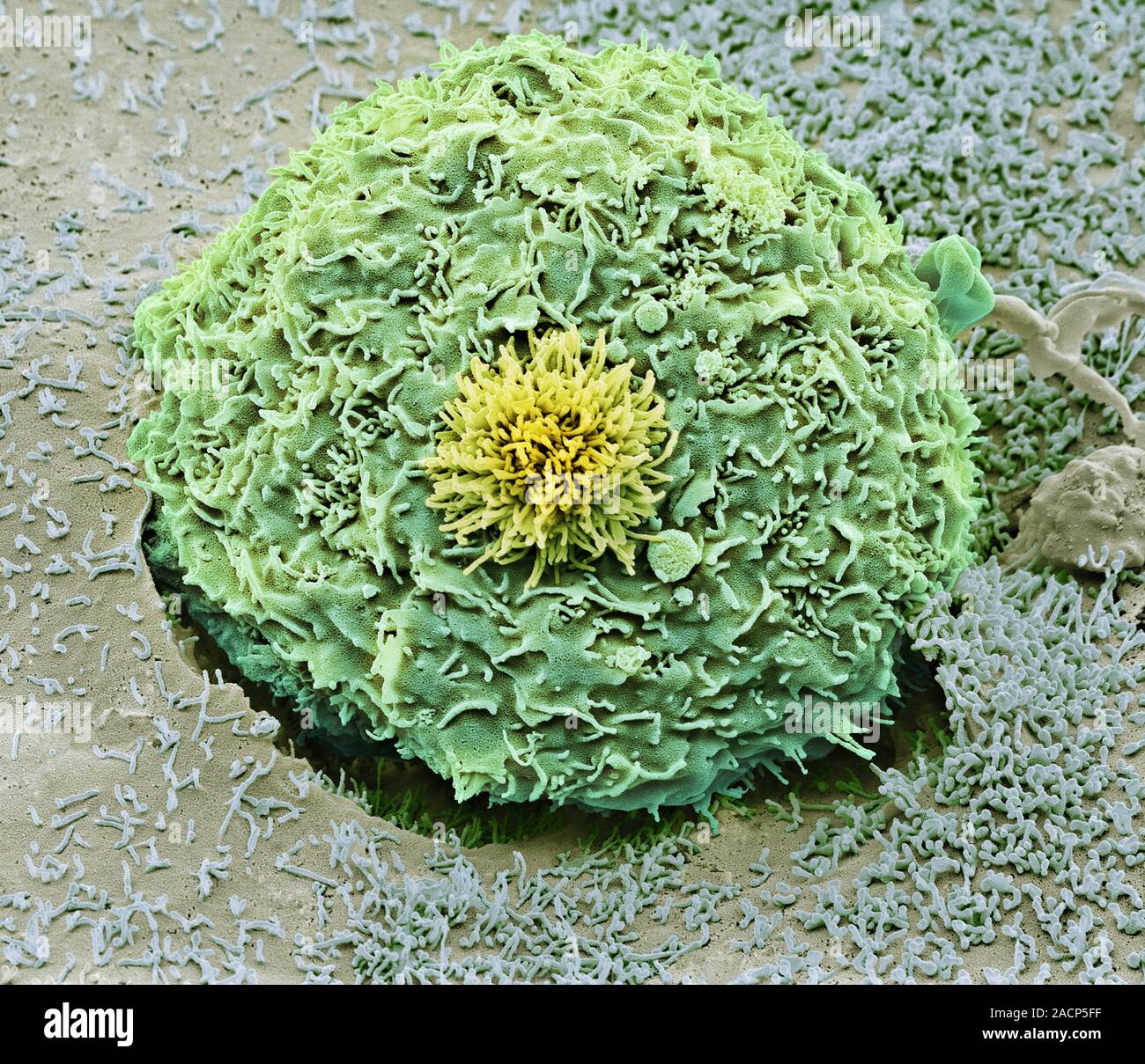 Colorectal cancer cell. Coloured scanning electron micrograph (SEM) of ...