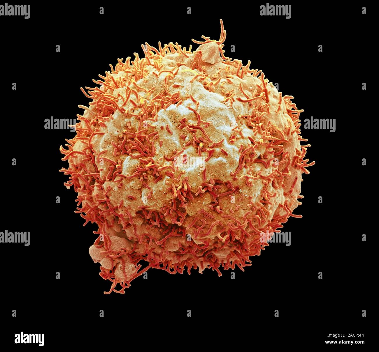 Liver cancer cell. Coloured scanning electron micrograph (SEM) of a ...