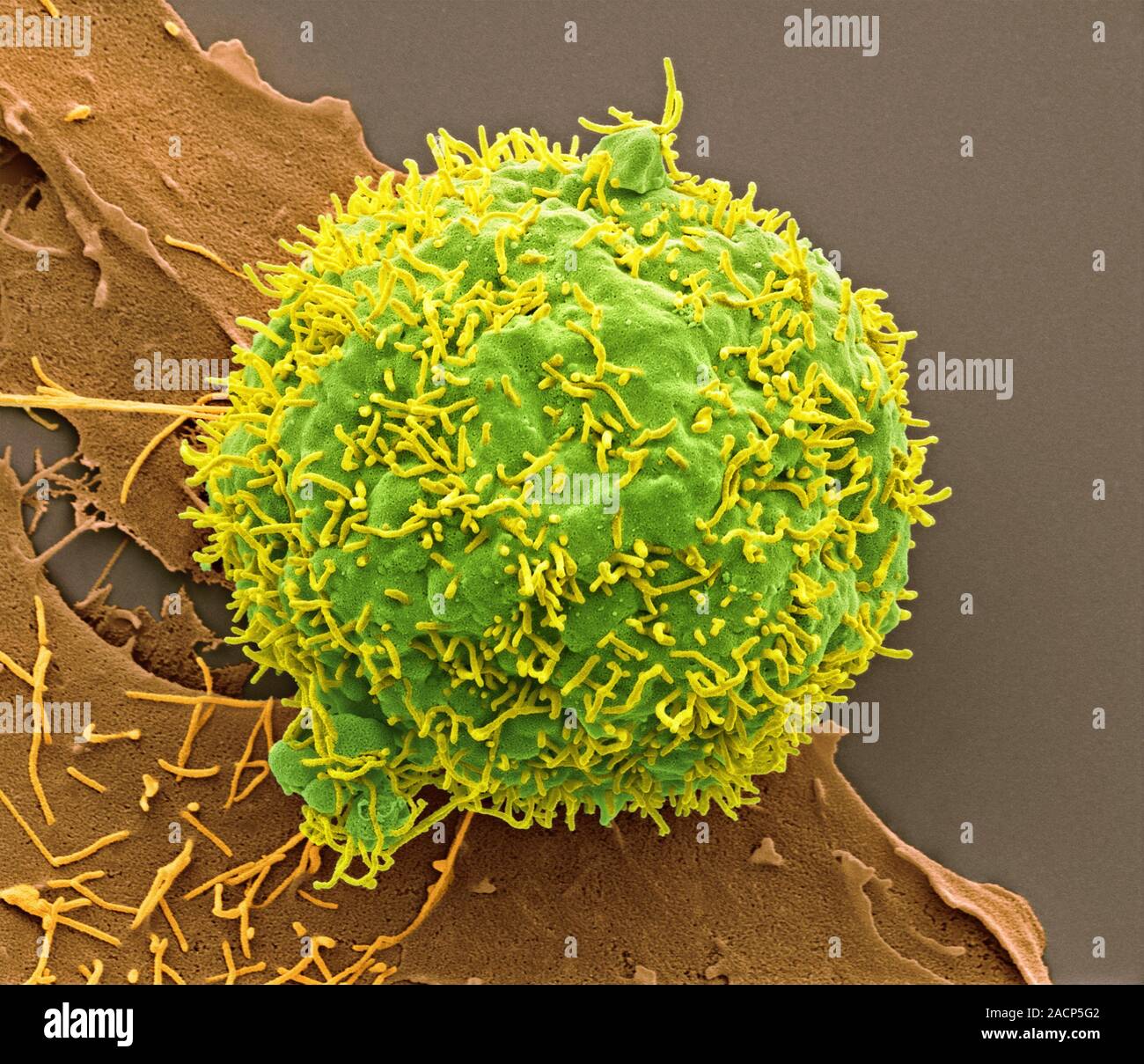 Liver cancer cell. Coloured scanning electron micrograph (SEM) of a ...