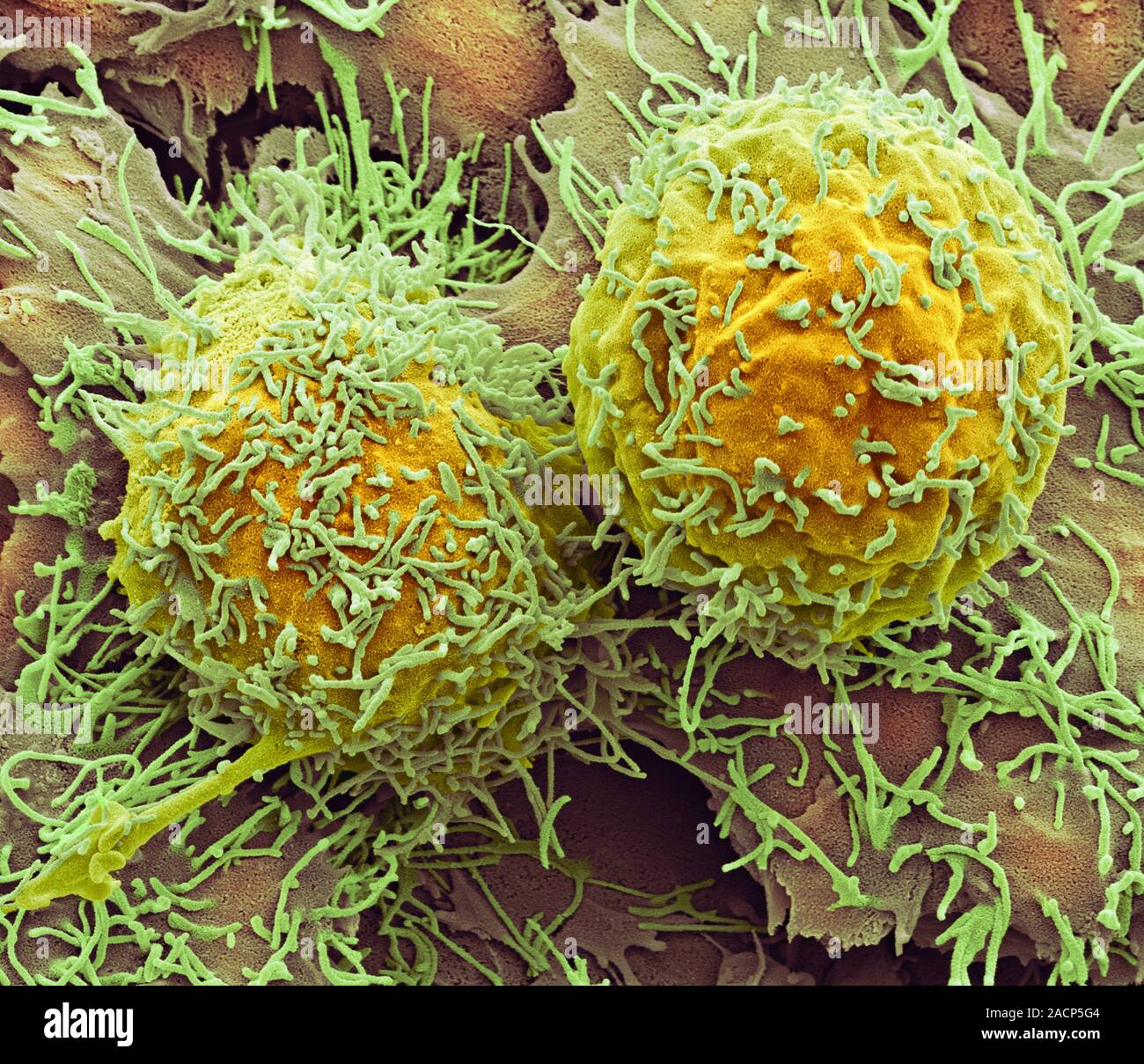 Liver cancer cells. Coloured scanning electron micrograph (SEM) of two ...