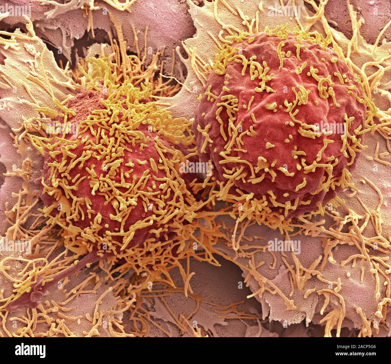 Liver cancer cells. Coloured scanning electron micrograph (SEM) of two ...