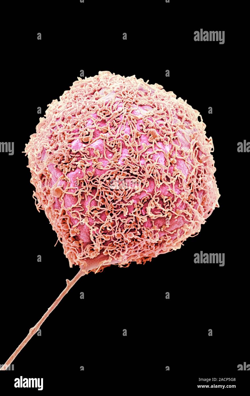 Bone cancer cell. Coloured scanning electron micrograph of an ...