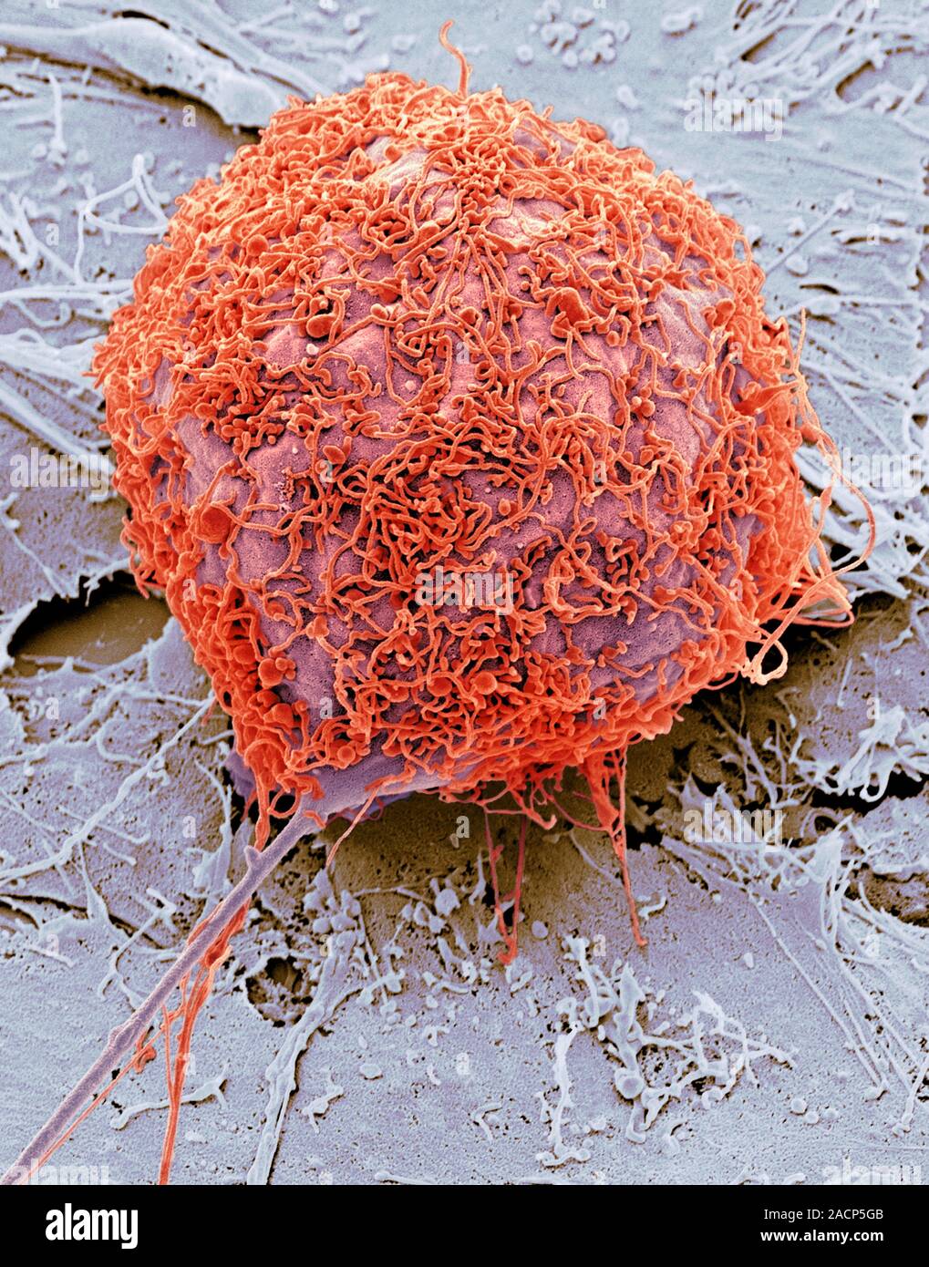 Bone cancer cell. Coloured scanning electron micrograph of an ...