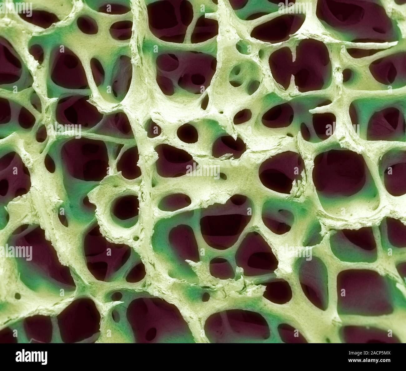 Bone tissue. Coloured scanning electron micrograph (SEM) of cancellous ...