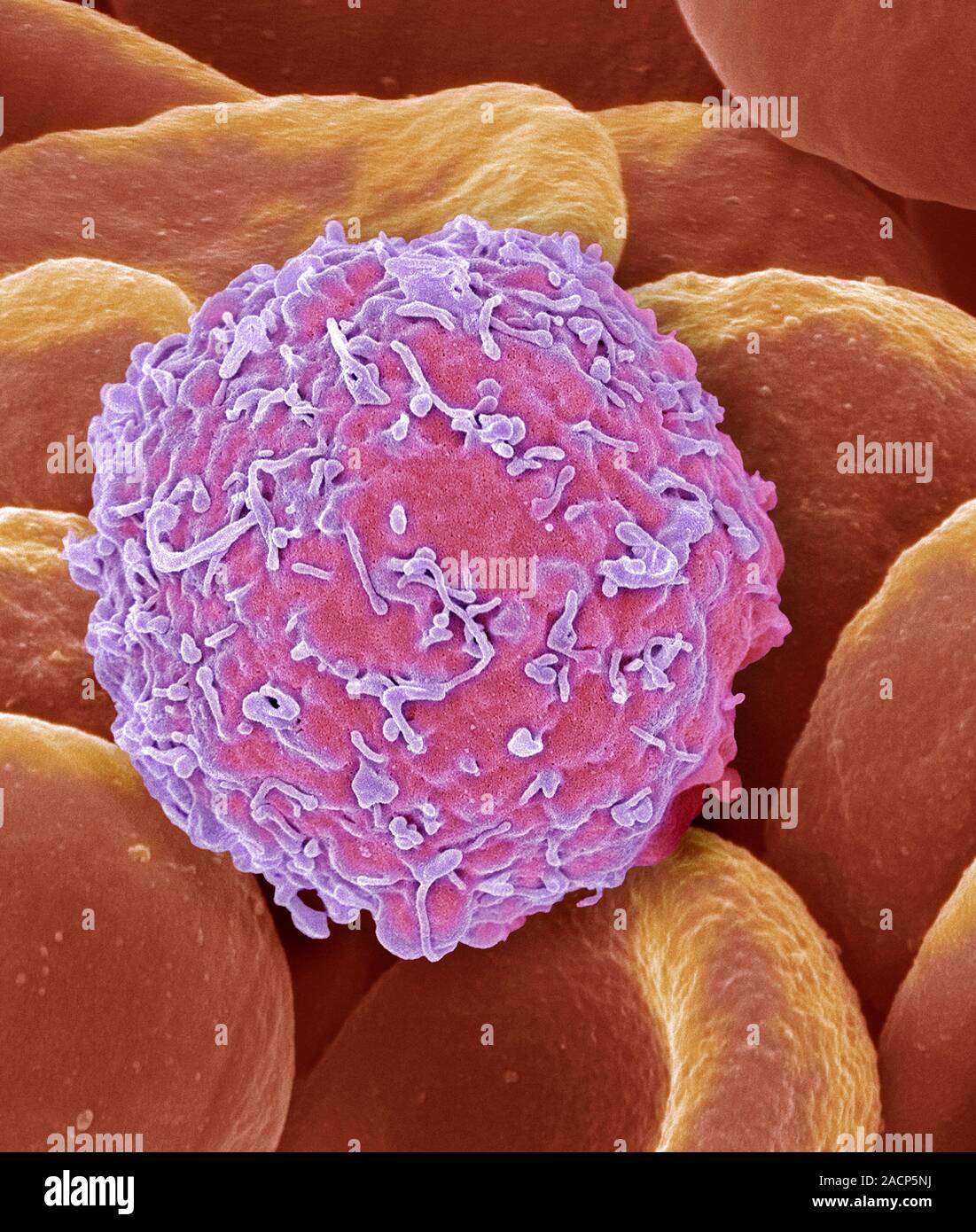 Leukaemia cell. Coloured scanning electron micrograph (SEM) of a ...