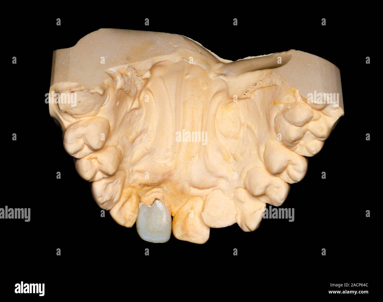 Dental model. Close-up of a clay cast of a human mouth with an ...