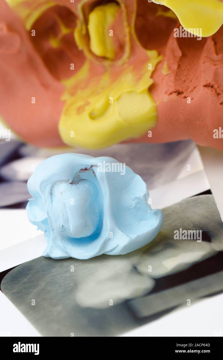 Dental cast. Close-up of a cast of a human tooth Stock Photo - Alamy