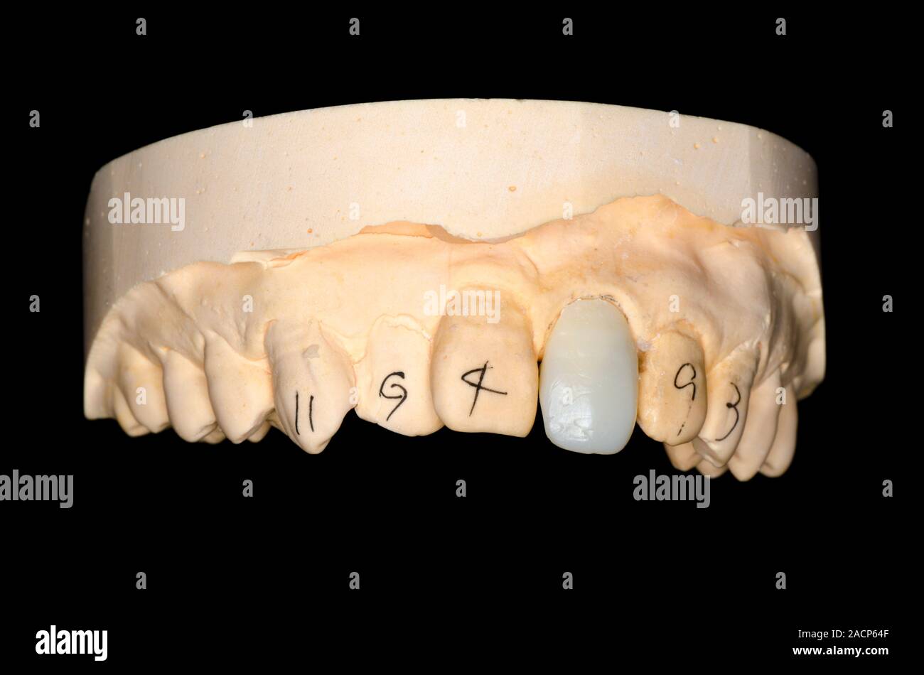 Dental model. Close-up of a clay cast of a human mouth with an ...