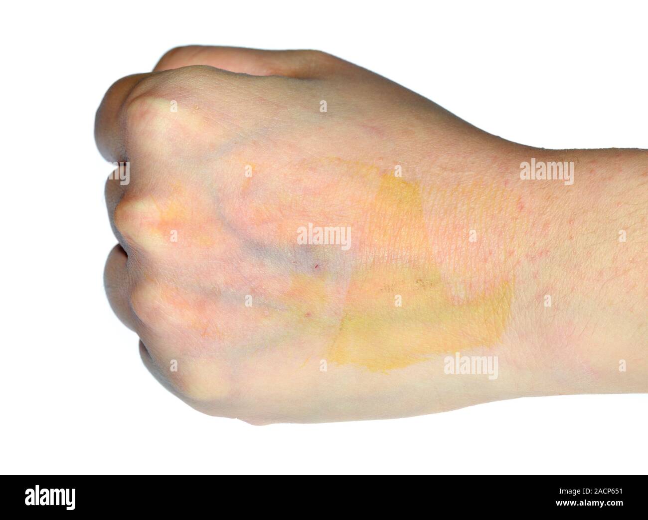 Oedema of the hand. Close-up of swollen skin on the hand of a woman ...
