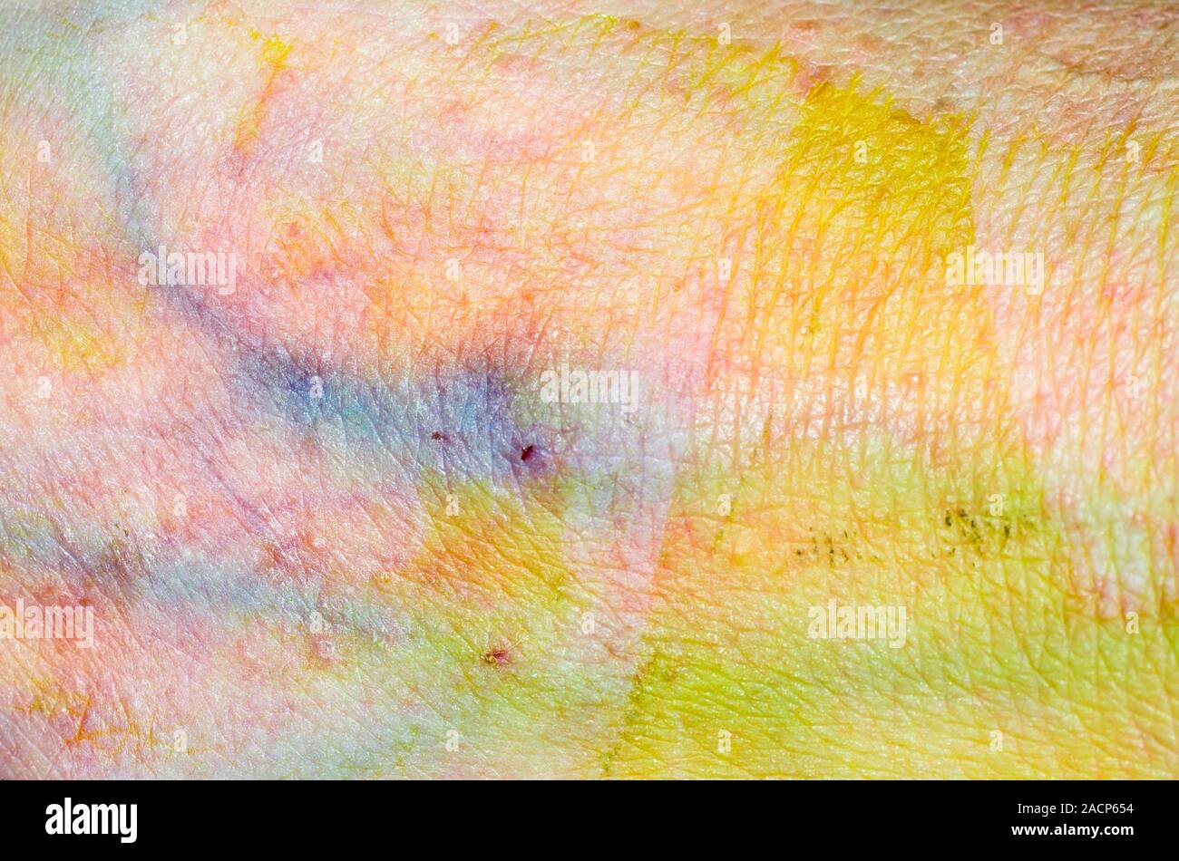 Oedema of the hand. Close-up of swollen skin on the hand of a woman ...