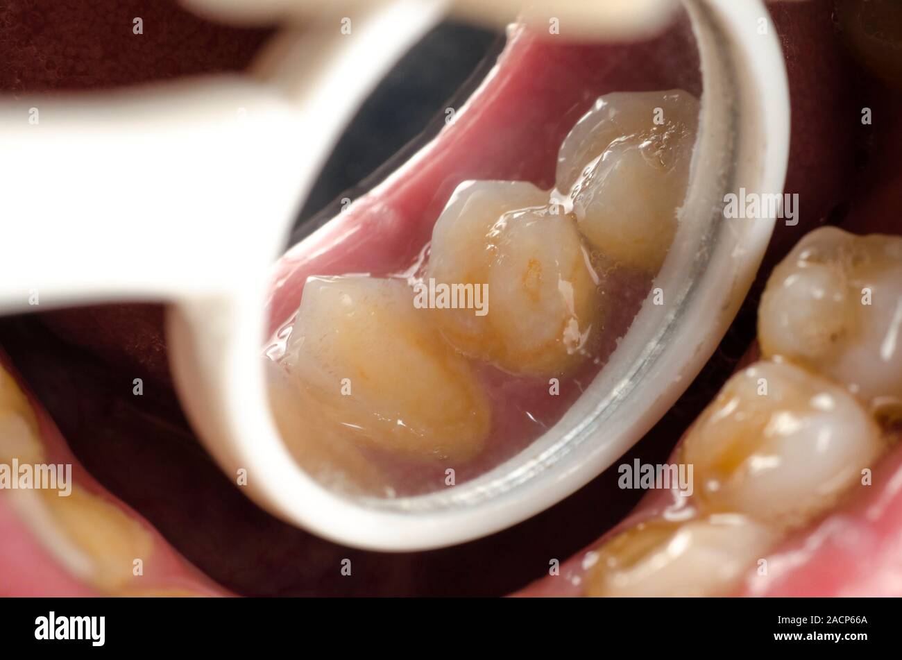 Dental inspection. Close-up of a patient's teeth being inspected with a ...