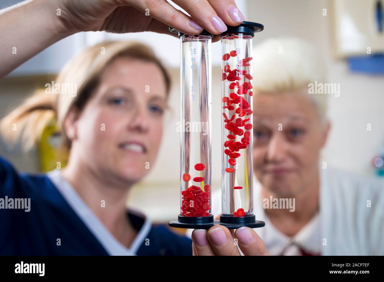 Diabetes education. Nurse using models to demonstrate high blood ...