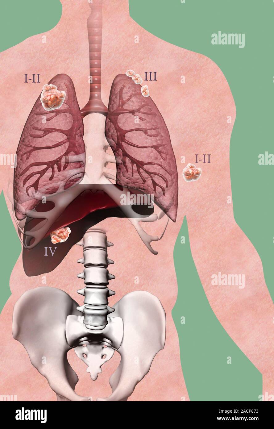 Metastatic cancer. Computer artwork of a section through a person's ...
