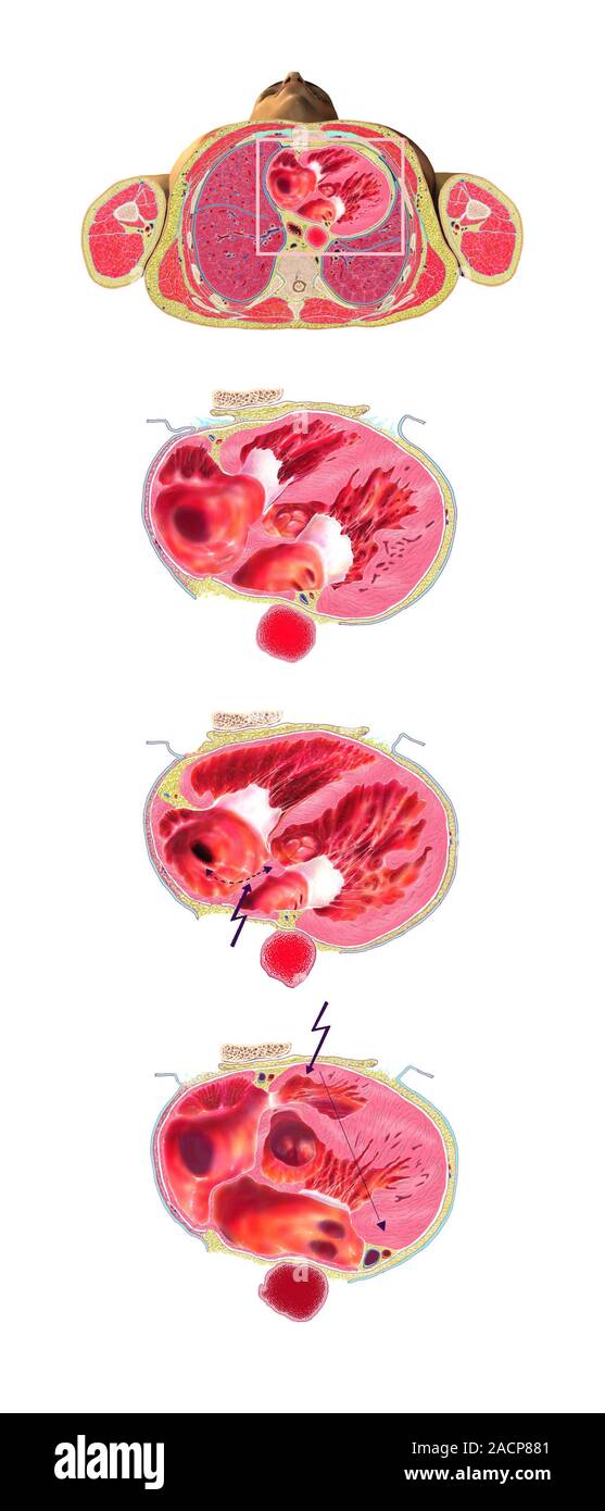 Human heart. Anatomical computer artwork of transverse sections through ...
