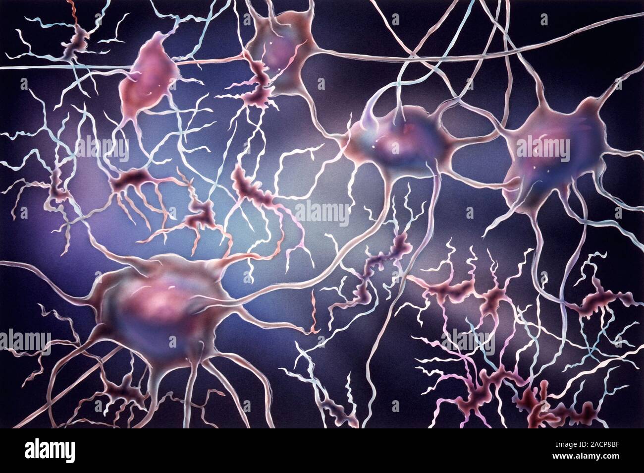 Nerve cell degeneration. Computer artwork showing a collection of nerve ...