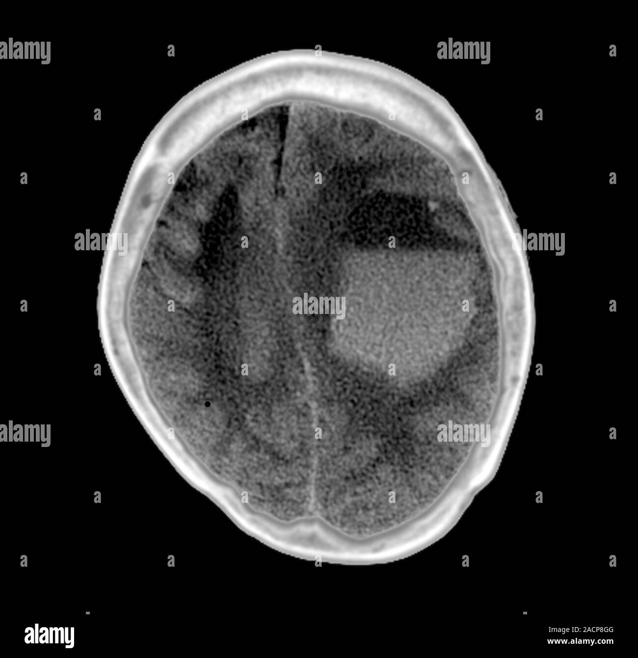 Brain haemorrhage. Computed tomography (CT) scan of the brain of a 57 ...