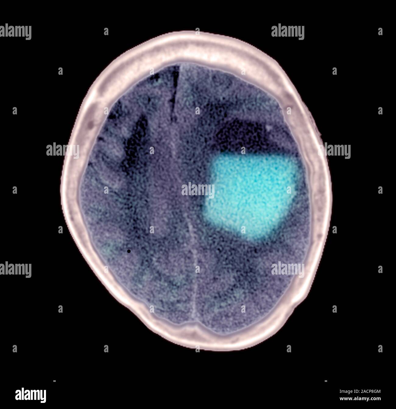 Brain haemorrhage. Coloured computed tomography (CT) scan of the brain of a 57 year old woman ...