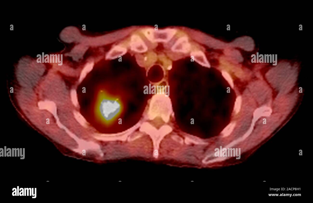 Lung cancer. Coloured combined computed tomography (CT) and positron ... Lung cancer. Coloured combined computed tomography (CT) and positron ...