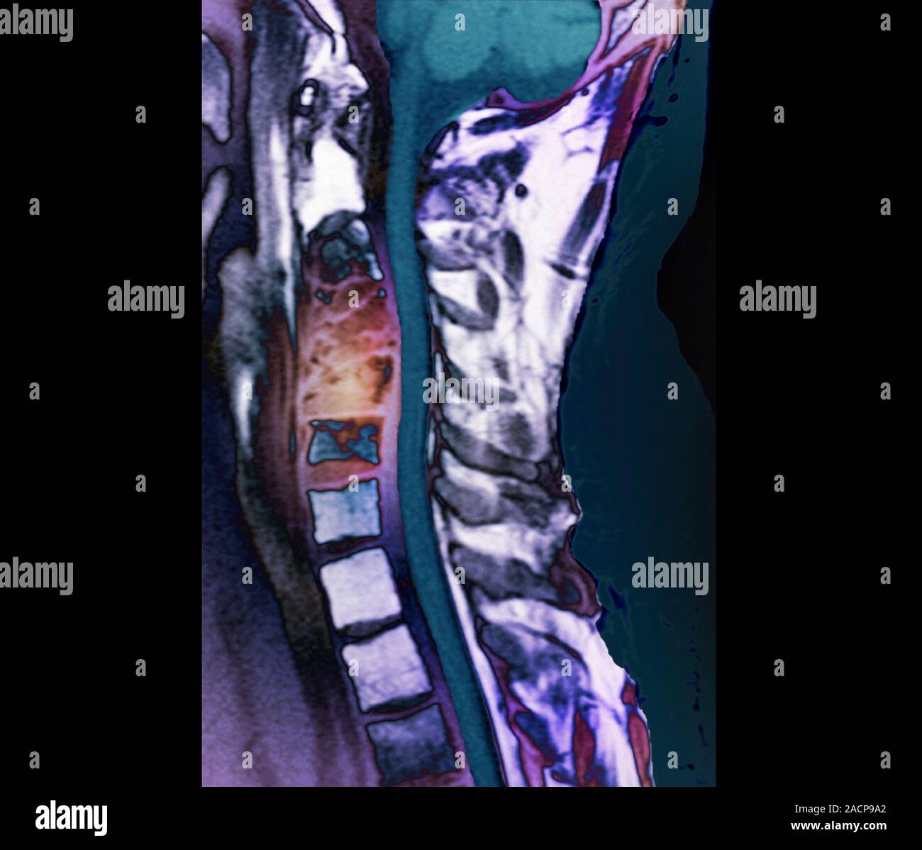 Spinal cancer. Coloured magnetic resonance imaging (MRI) scan of a ...