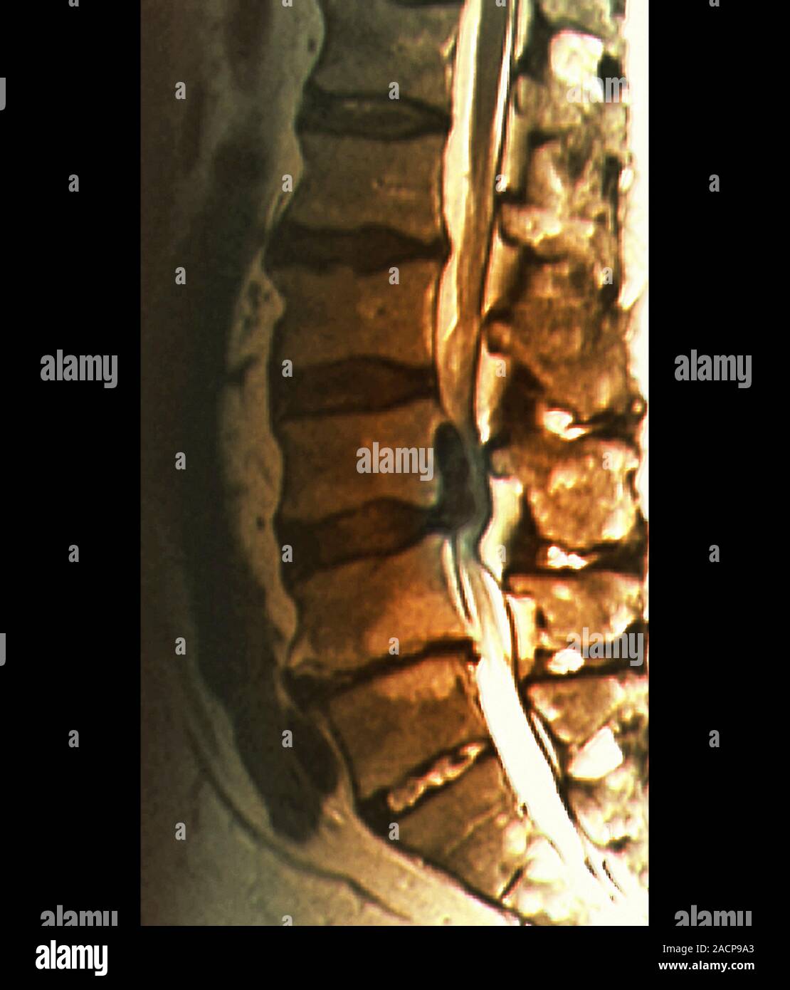 Sciatica. Coloured magnetic resonance imaging (MRI) scan of a sagittal ...