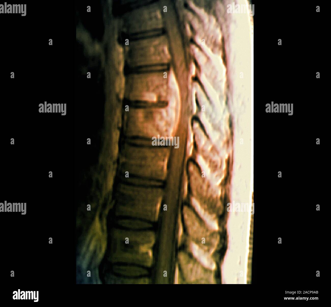 Spondylodiscitis. Coloured magnetic resonance imaging (MRI) scan of a ...