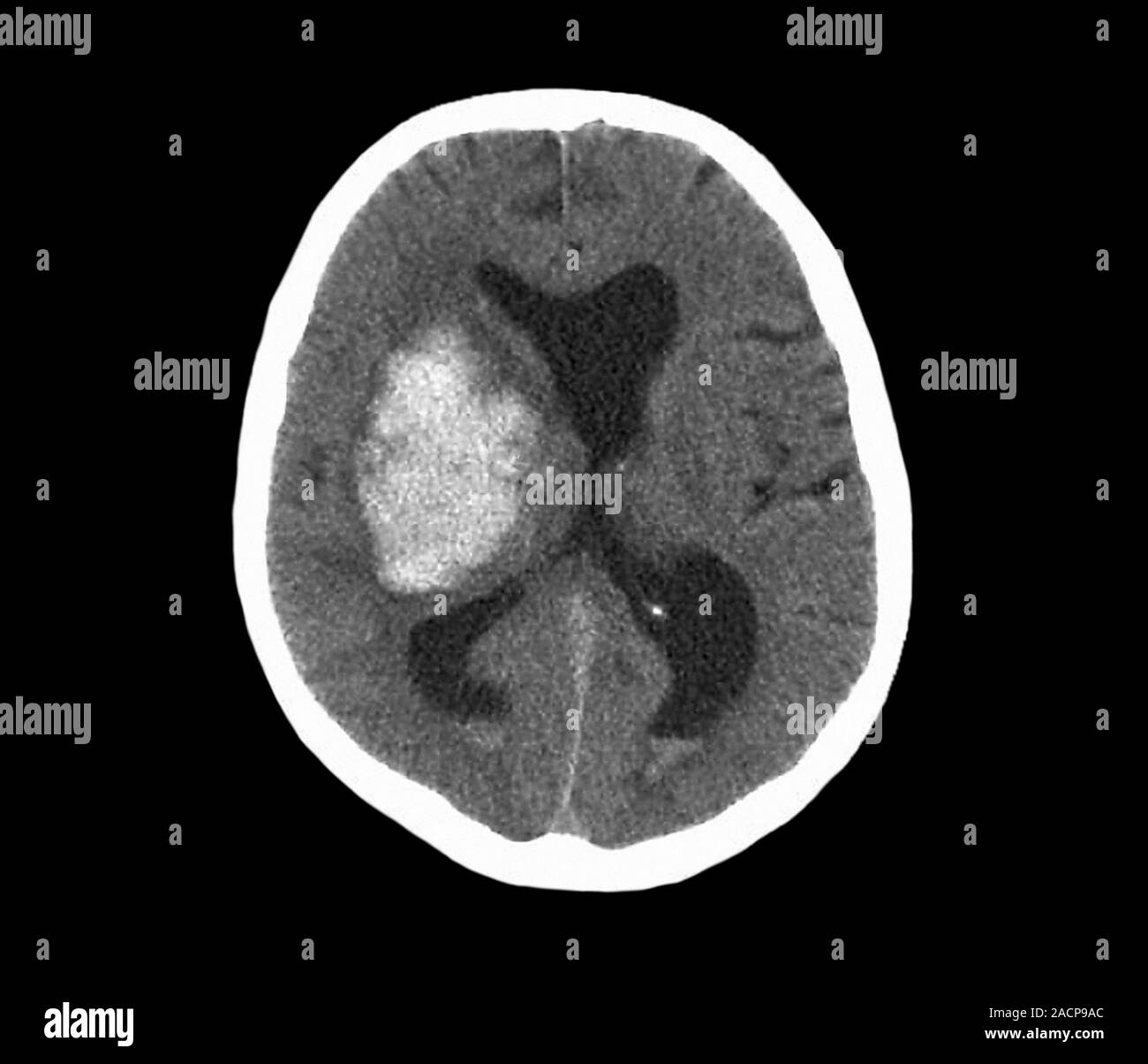 Stroke. Computed tomography (CT) scan of a section through the brain of ...