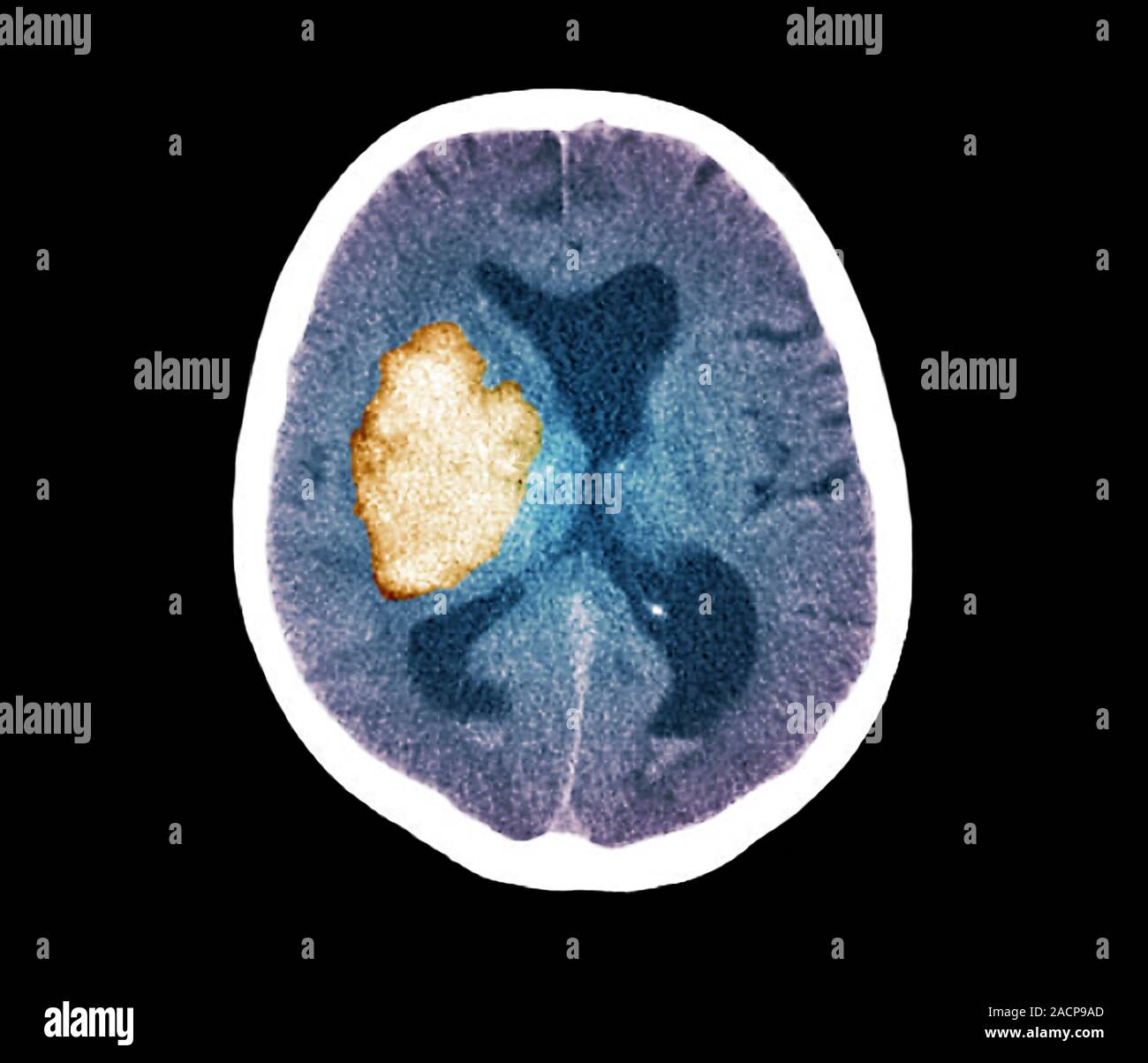 Stroke. Coloured computed tomography (CT) scan of a section through the ...