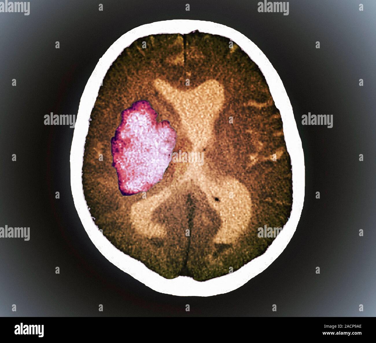 Stroke. Coloured computed tomography (CT) scan of a section through the brain of a patient 24 ...