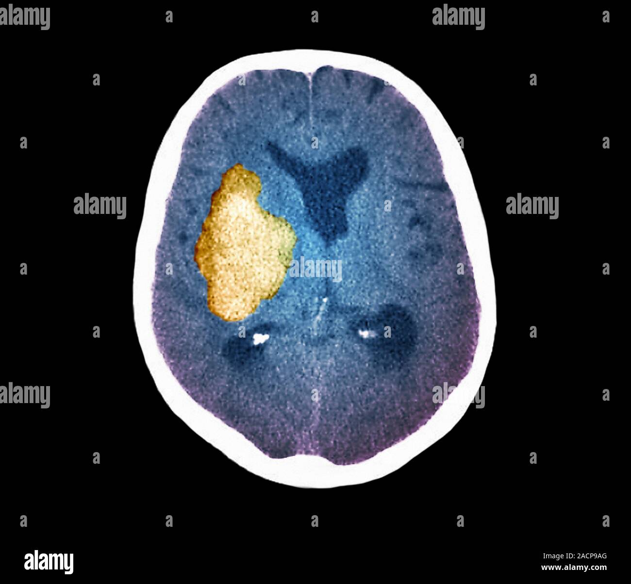 Stroke. Coloured computed tomography (CT) scan of a section through the ...
