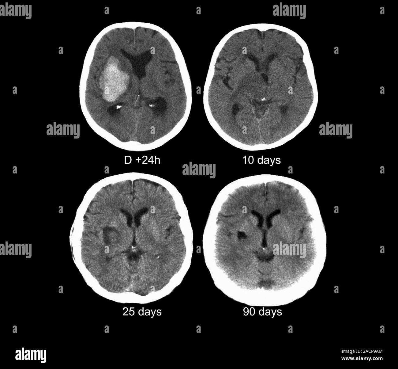 Stroke. Computed tomography (CT) scans of sections through the brain of ...
