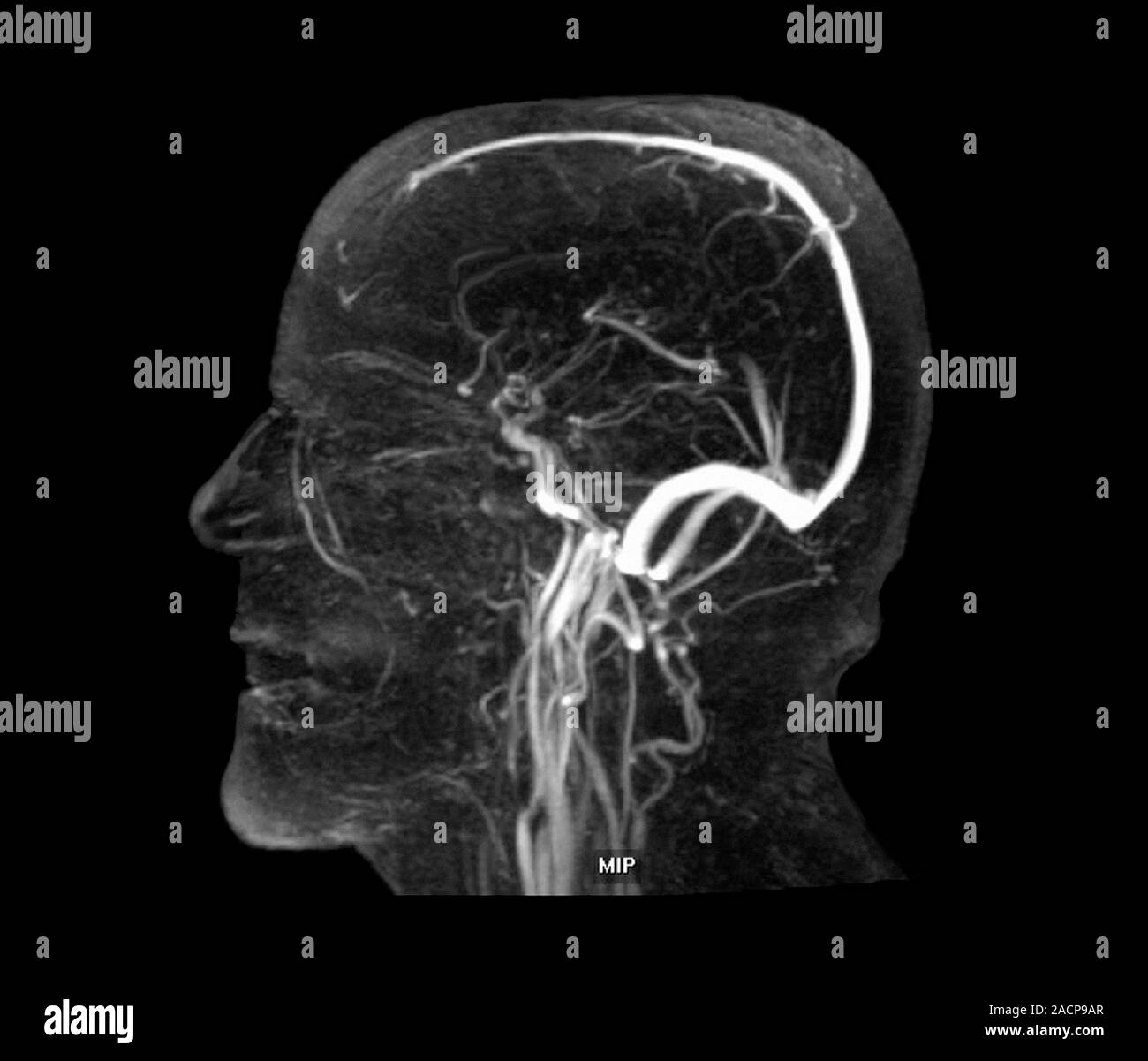 Vascular system of the head. Magnetic resonance imaging (MRI) angiogram ...