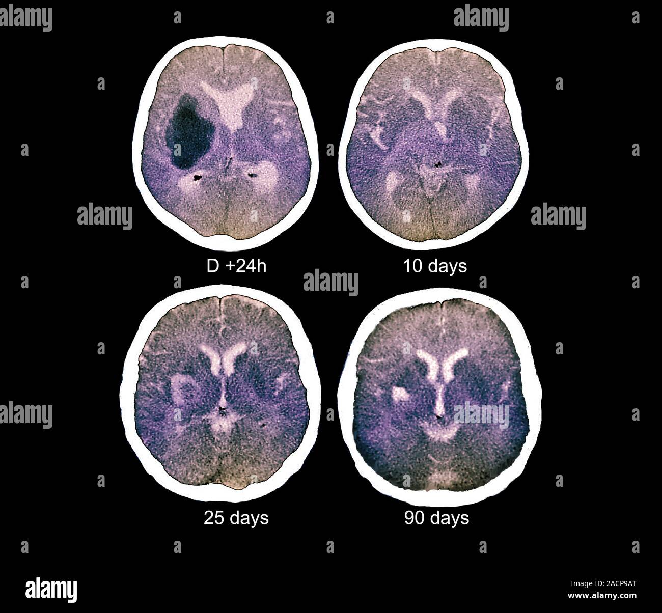 Stroke. Coloured computed tomography (CT) scans of sections through the ...