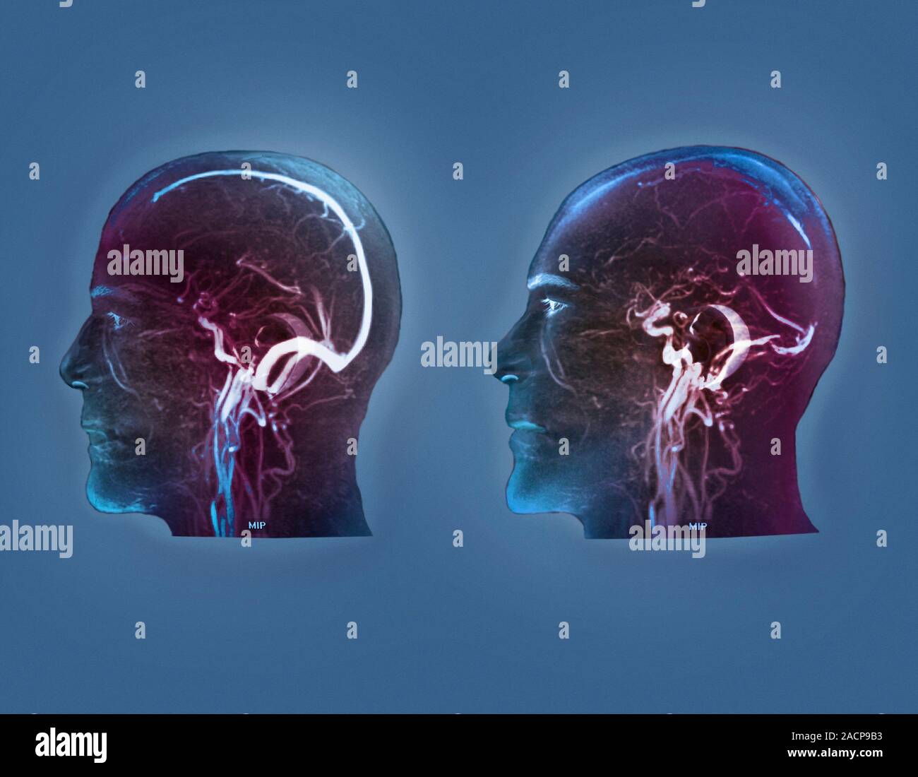 Thrombophlebitis in the brain. Coloured magnetic resonance imaging (MRI ...